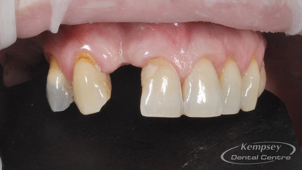 Porcelain Veneers - Dental veneers - Kempsey Dentist veneers