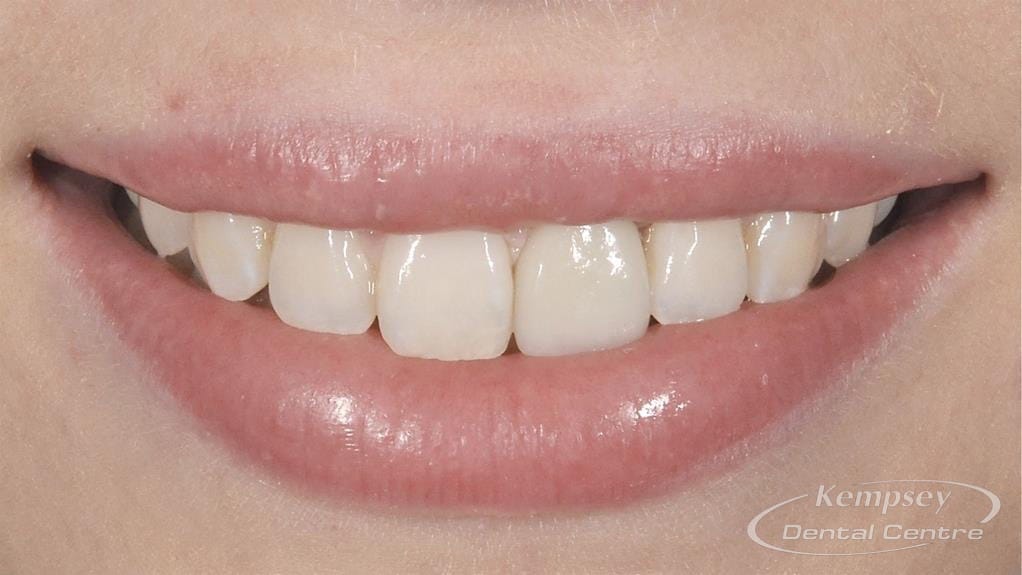 3D Guided Implant Placement - Kempsey Implant Dentist