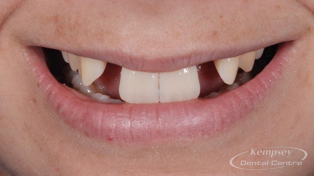 Tooth implant - Pain free Digital tooth implant - Kempsey Implant Dentist